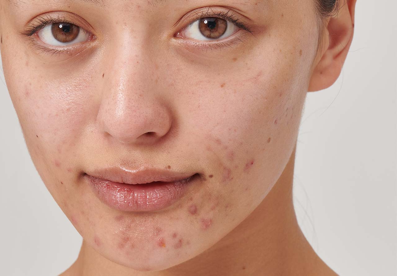 How To Care For Stressed Skin | The INKEY List