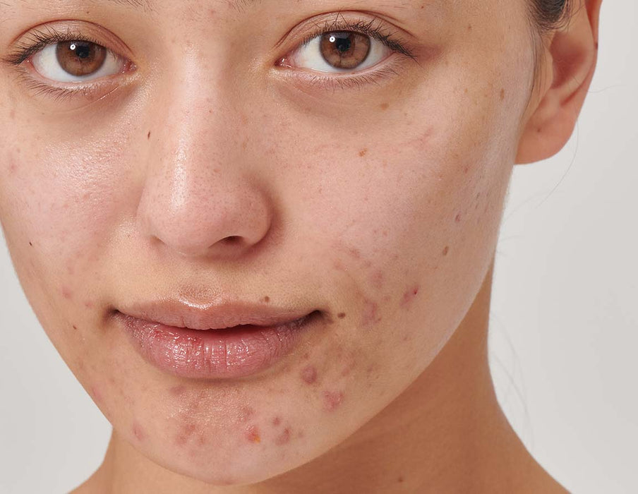 How To Care For Stressed Skin | The INKEY List